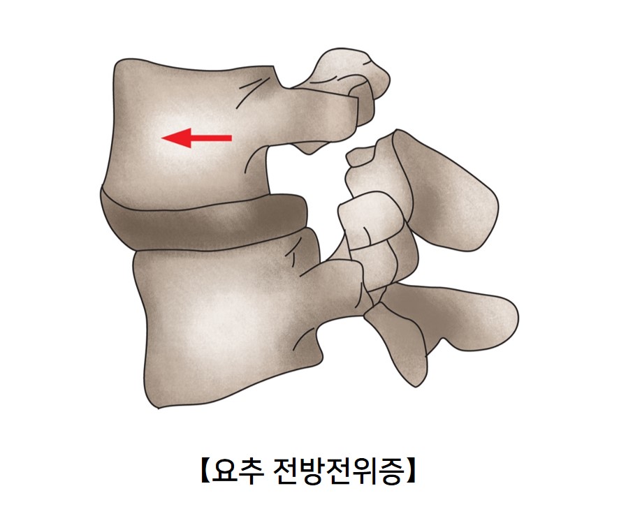 요추 전방전위증 질환백과 의료정보 건강정보 서울아산병원